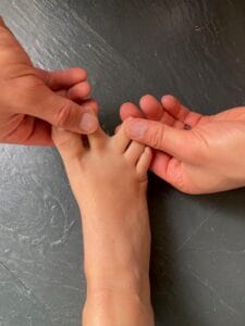 Treatments for Bunions - Physical Therapy Simplified